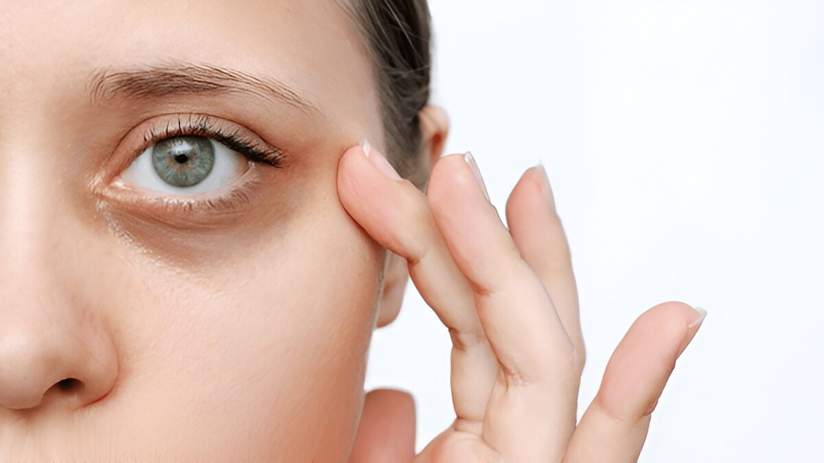 Undereye Treatment in Delhi – Reduce Dark Circles & Puffiness